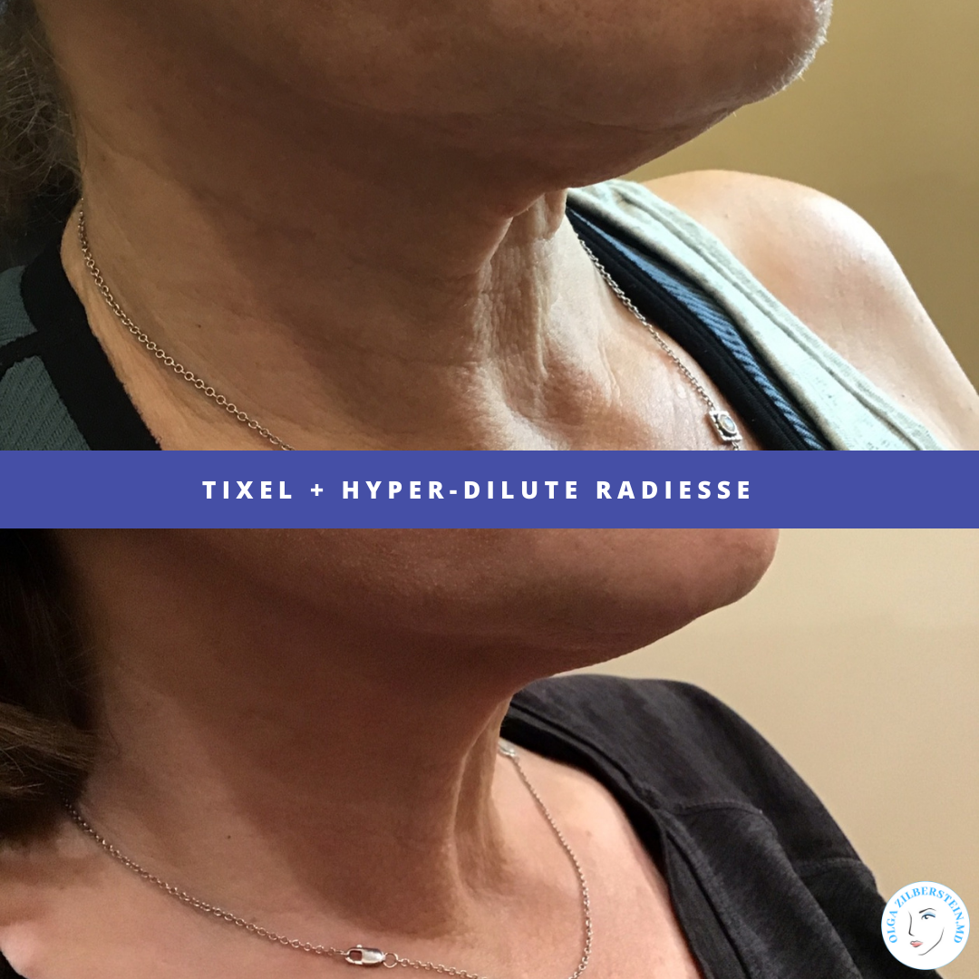 Neck Tightening Procedures | Dr. Olga Zilberstein