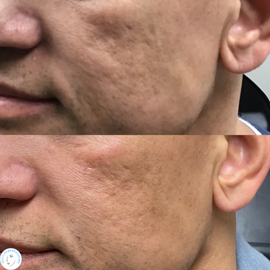 Scar & Stretch Mark Treatments | Dr. Olga Zilberstein