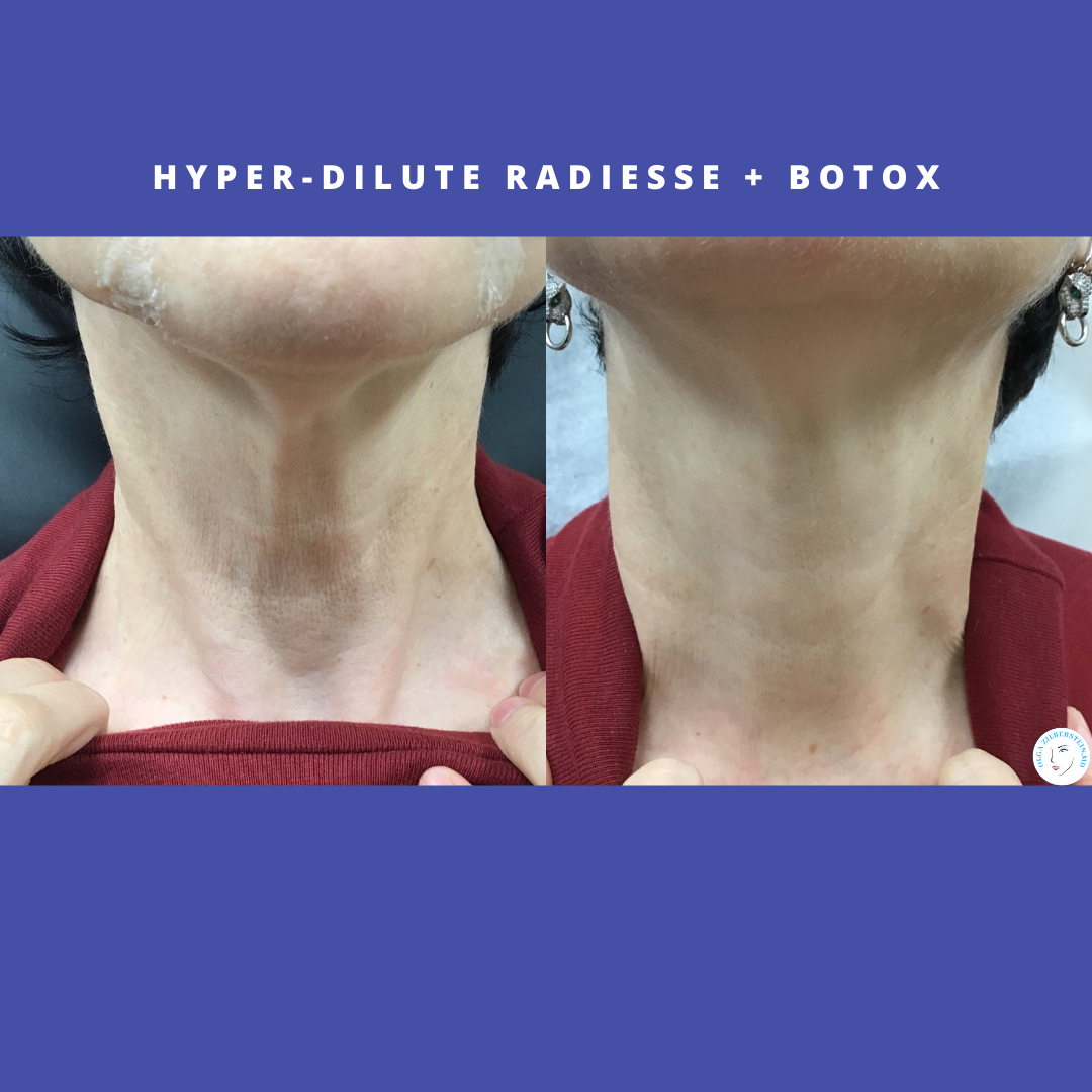 Neck Tightening Procedures | Dr. Olga Zilberstein