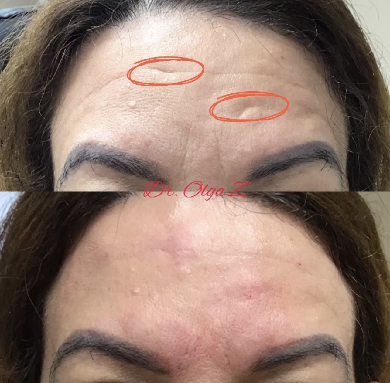 Scars / Stretch Marks / Acne Scars | Dr. Olga Zilberstein