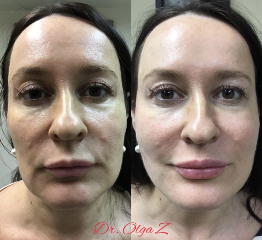 Non-Surgical Face Lift | Dr. Olga Zilberstein