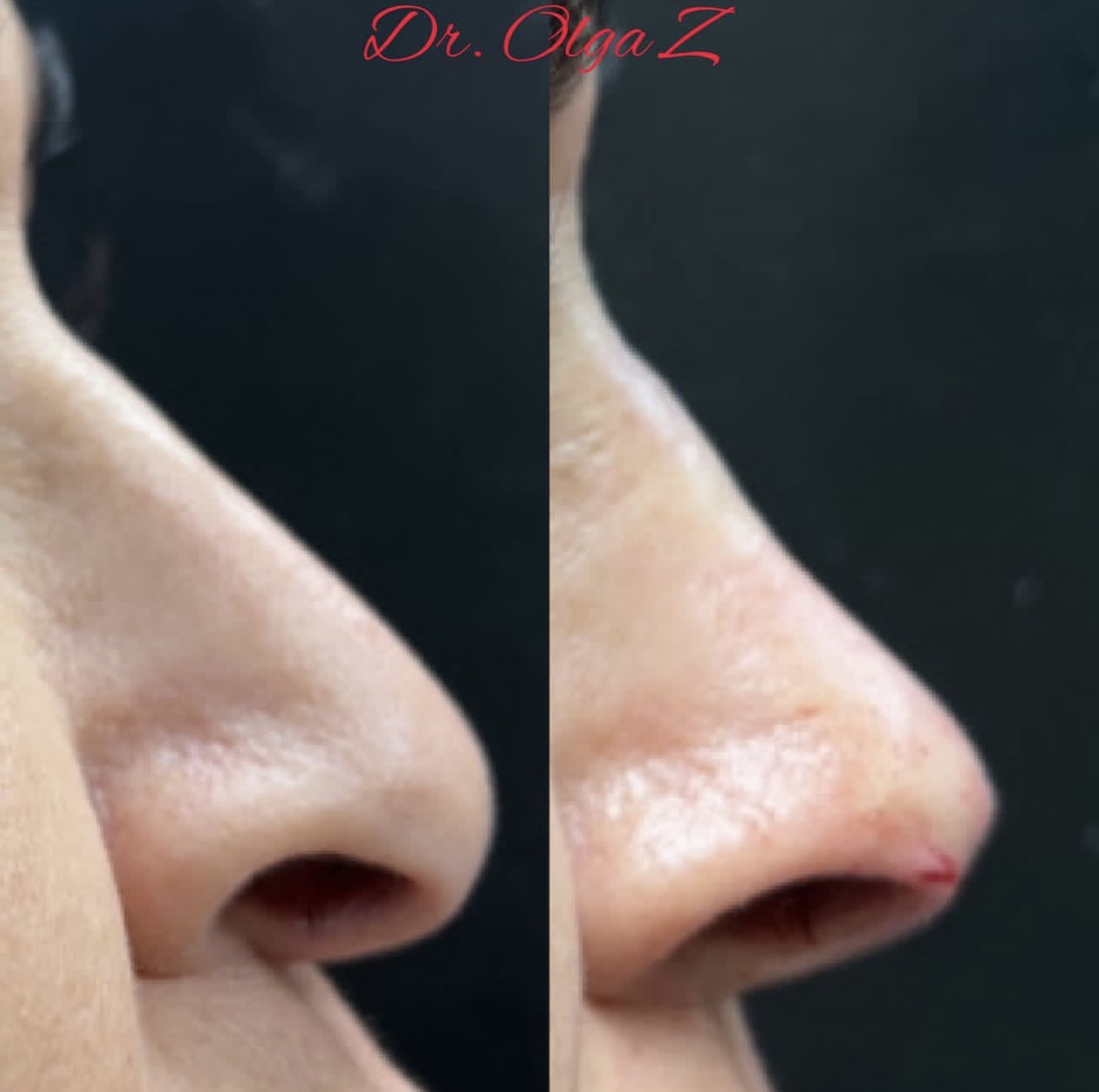 Non-Surgical Nose Job | Dr. Olga Zilberstein