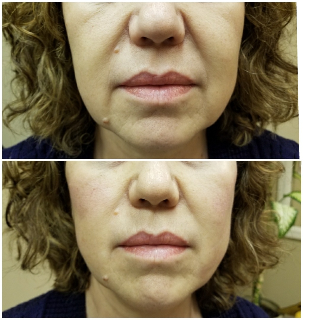 PDO/PCL Thread-Lift | Dr. Olga Zilberstein