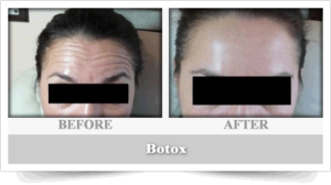 Botox in Long Island and Brooklyn | Dr. Olga Zilberstein