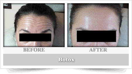 Botox in Long Island and Brooklyn | Dr. Olga Zilberstein
