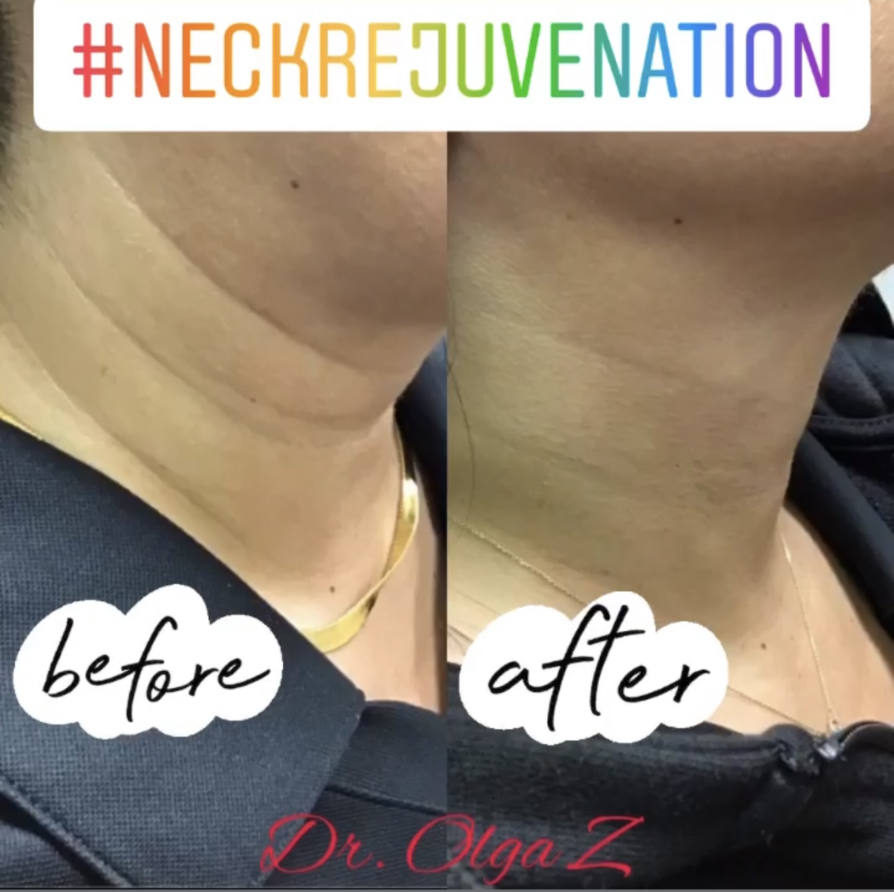 Neck Rejuvenation | Dr. Olga Zilberstein