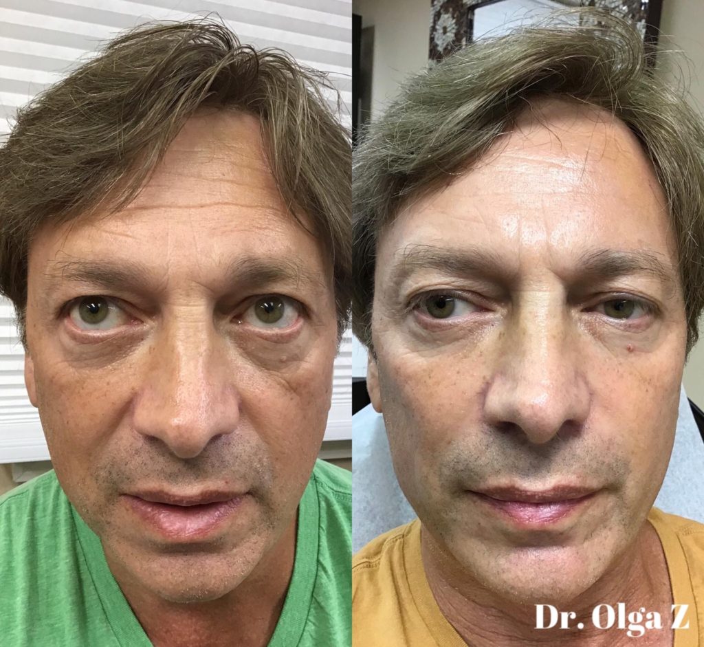 Non-Surgical Face Lift | Dr. Olga Zilberstein