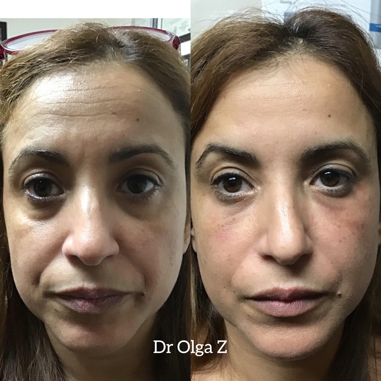 Non-Surgical Face Lift | Dr. Olga Zilberstein