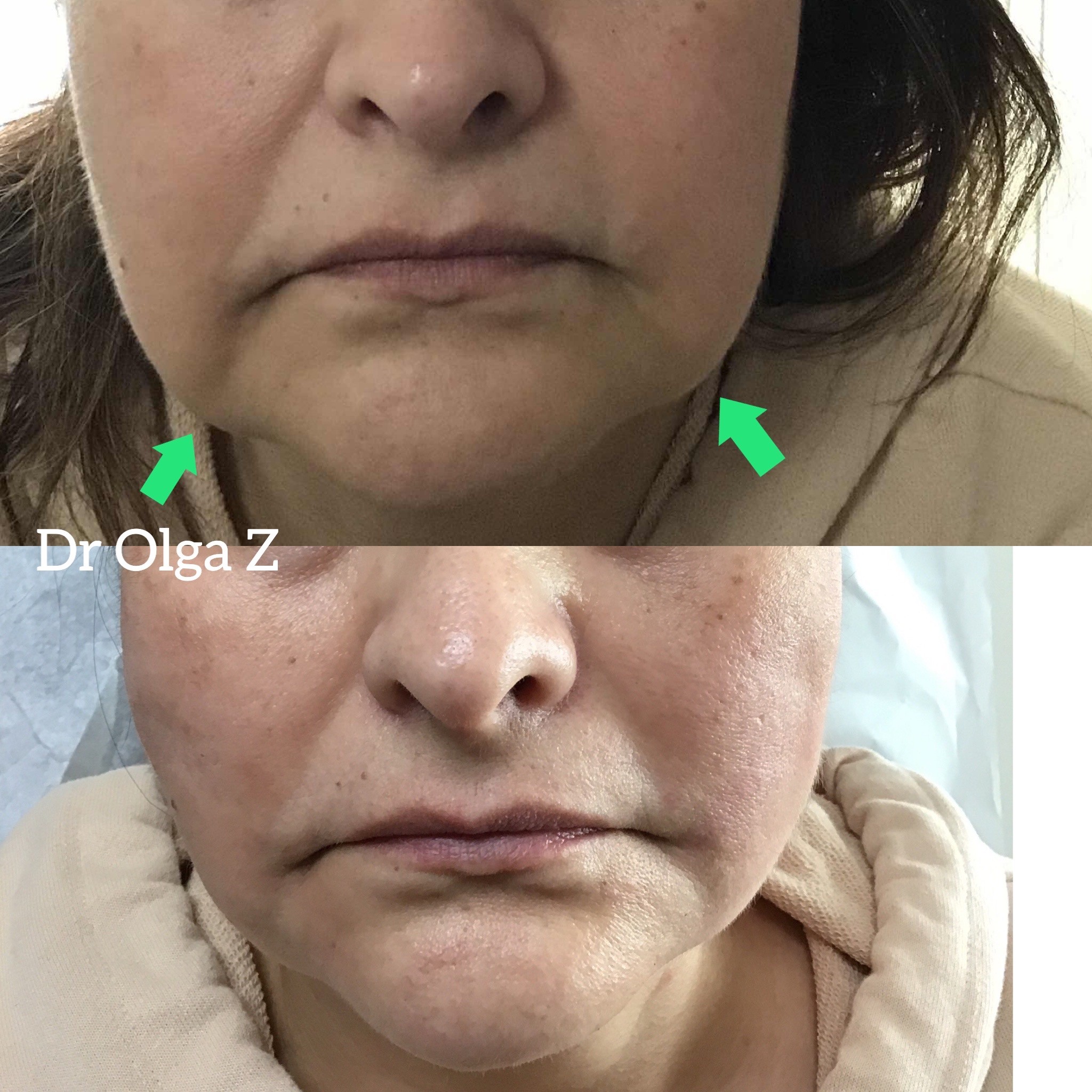 PDO/PCL Thread-Lift | Dr. Olga Zilberstein