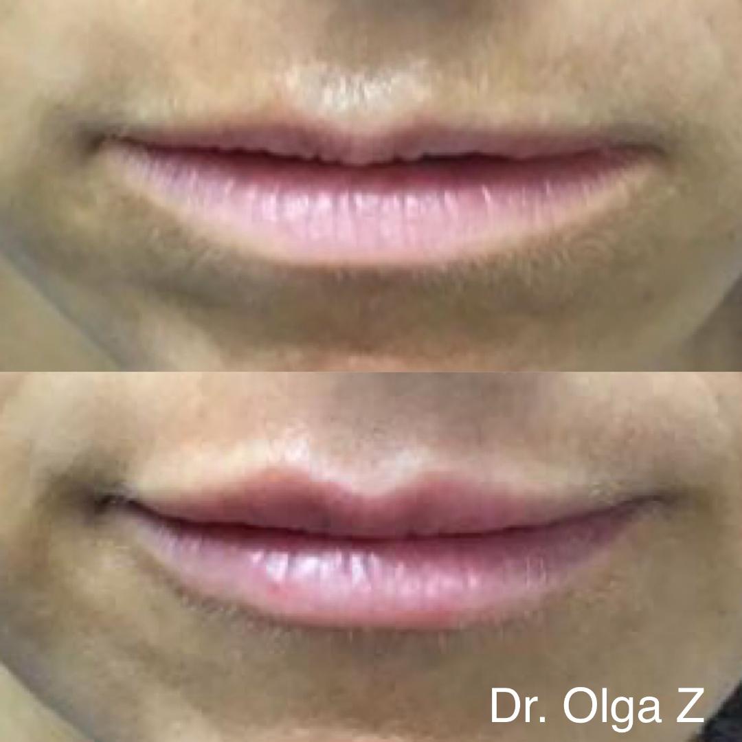 Lip Enhancement | Dr. Olga Zilberstein
