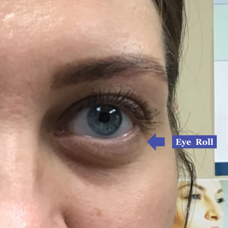 Upper and Lower Eyelid Treatments | Dr. Olga Zilberstein