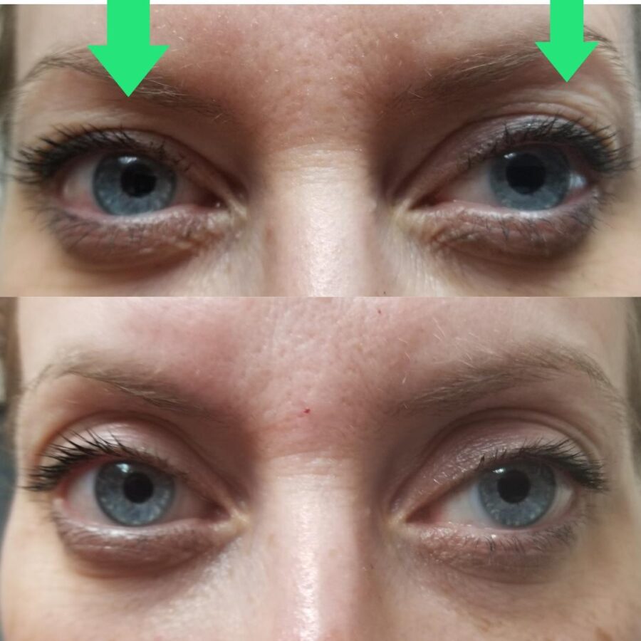 Non-Surgical Blepharoplasty | Dr. Olga Zilberstein