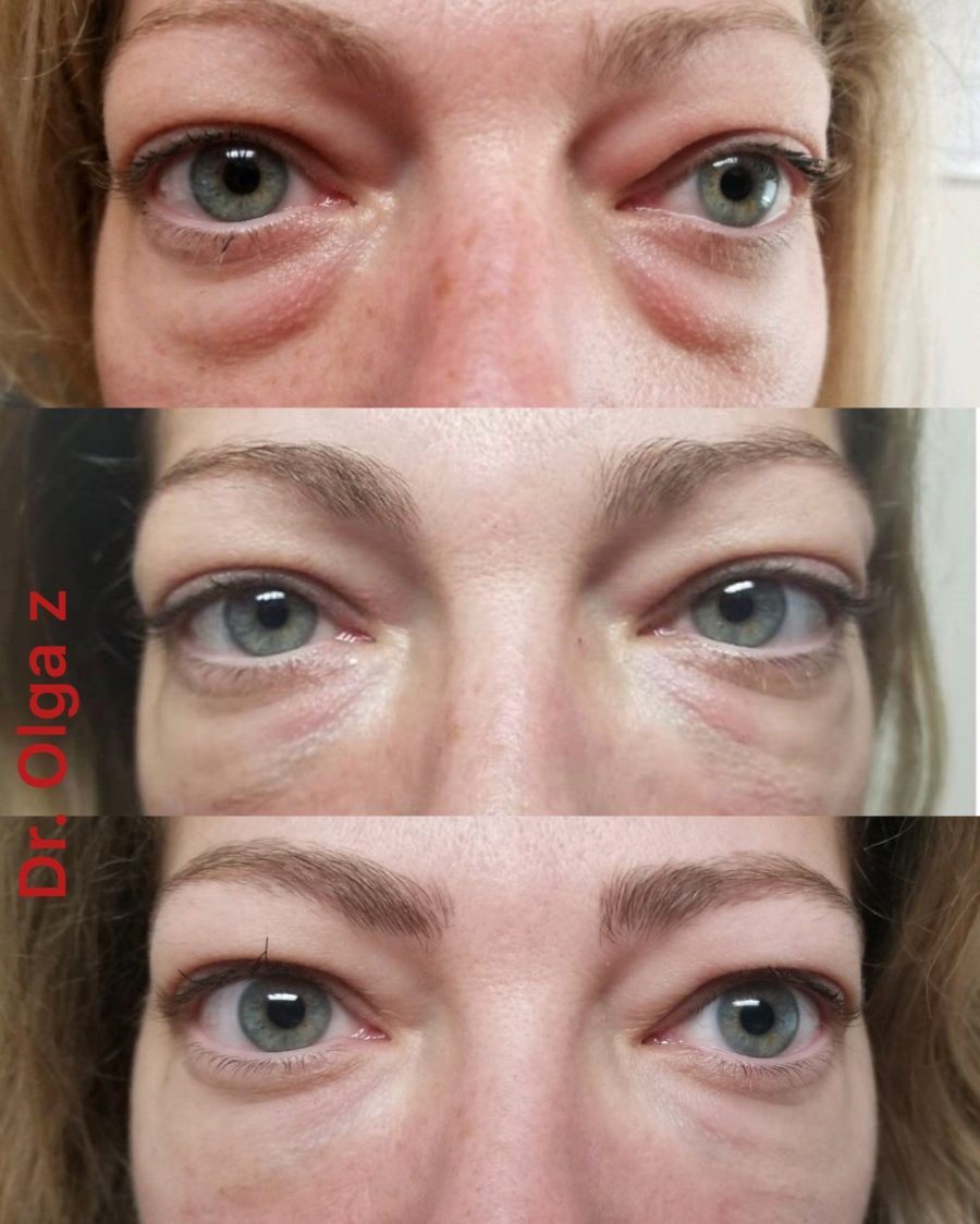 Non-Surgical Blepharoplasty | Dr. Olga Zilberstein