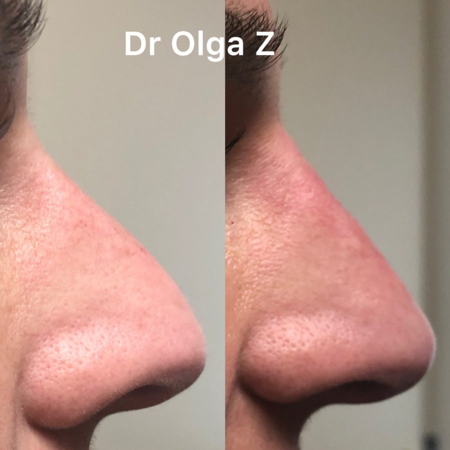 Non-Surgical Nose Job | Dr. Olga Zilberstein