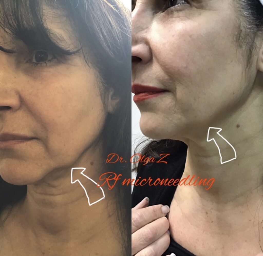Radio-Frequency Micro-Needling | Dr. Olga Zilberstein