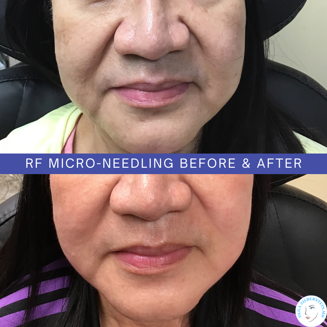 Skin Rejuvenation and Resurfacing | Dr. Olga Zilberstein