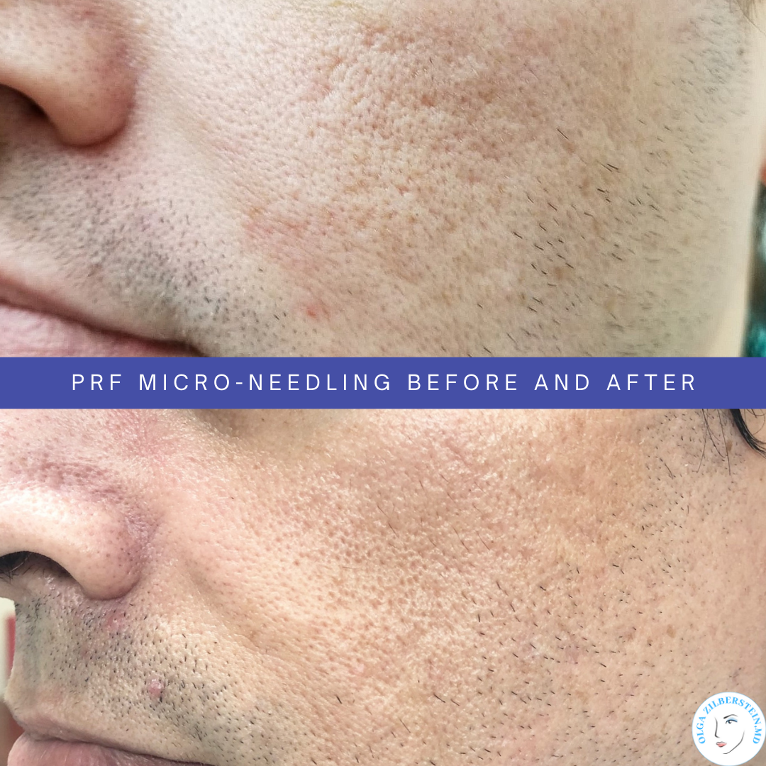 Skin Rejuvenation and Resurfacing | Dr. Olga Zilberstein