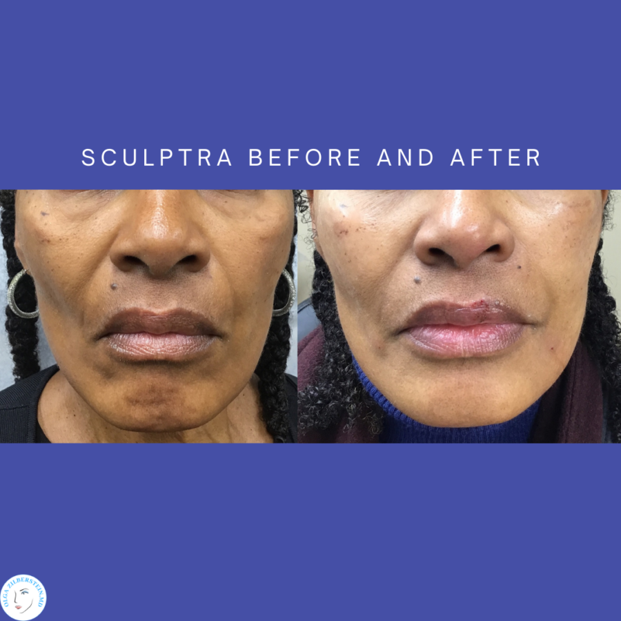 Skin Rejuvenation and Resurfacing | Dr. Olga Zilberstein