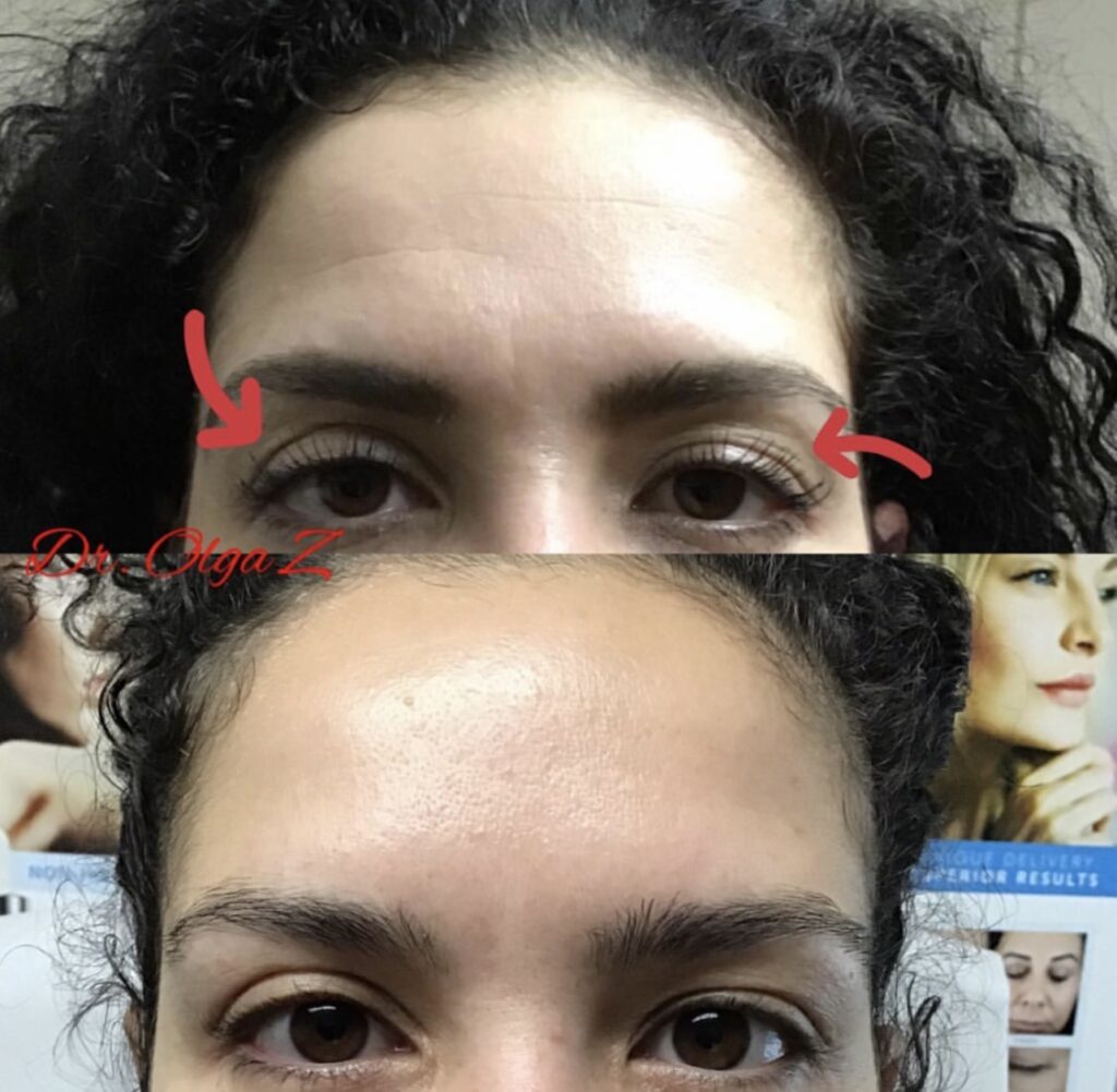 Botox in Long Island and Brooklyn | Dr. Olga Zilberstein