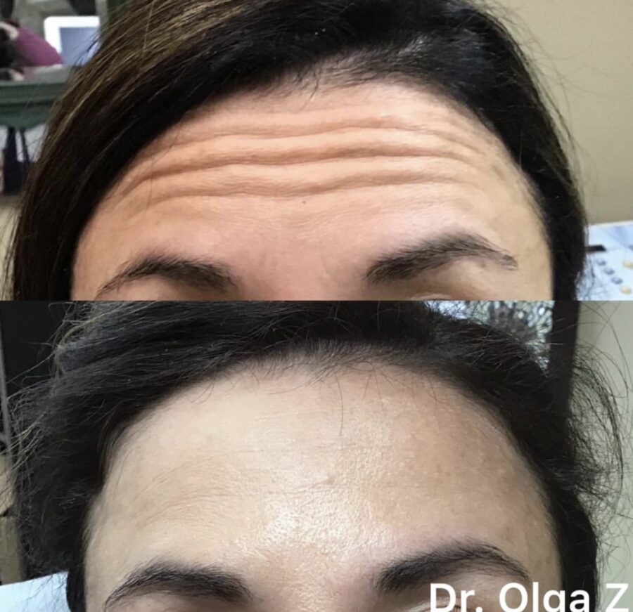 Botox in Long Island and Brooklyn | Dr. Olga Zilberstein